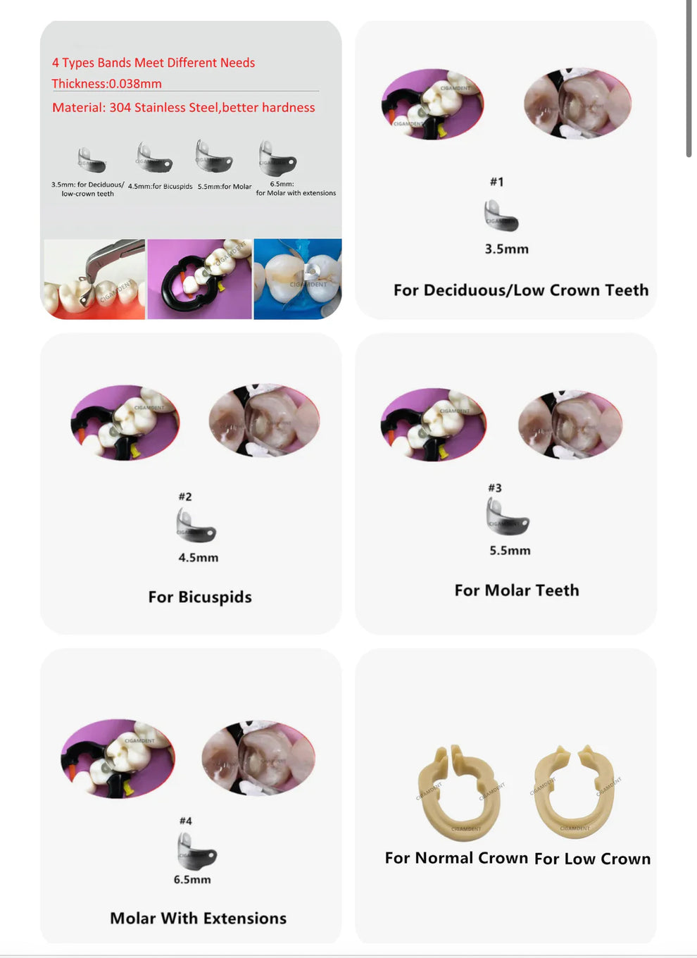 Dental Matrix Refill Matrices Sectional Matrices Fit Garrison Palodent – TQL Healthcare